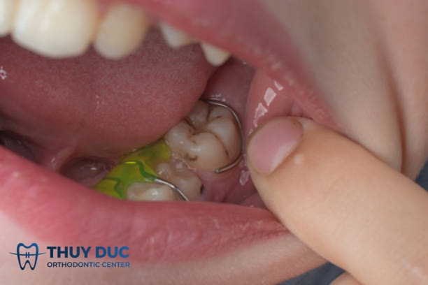 Sâu Kẽ Răng Khi Niềng Và Phương Pháp Xử Lý Hiệu Quả
