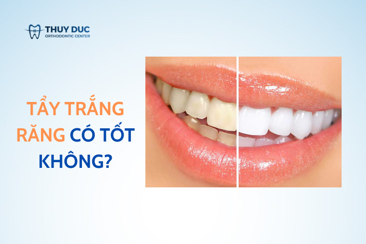 Tẩy trắng răng có tốt không? Nên tẩy răng bằng phương pháp nào? - Bác ...